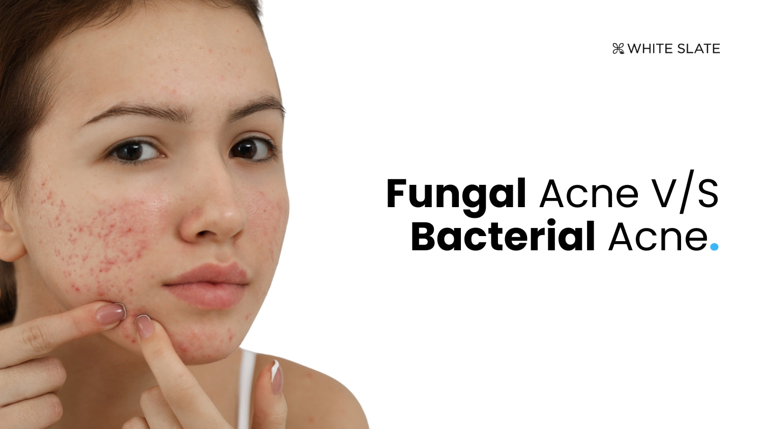 Fungal Acne vs Bacterial Acne: What’s Causing Your Breakouts? – WHITE SLATE