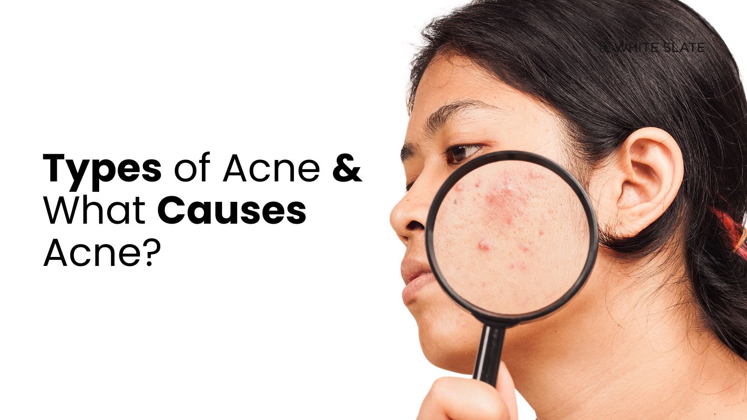 Types of Acne & What Causes Acne? – WHITE SLATE